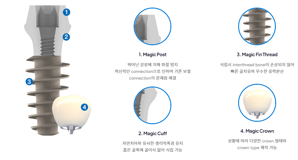 IBS 임플란트 종류 및 가격, 장단점